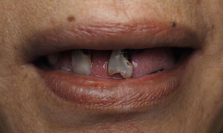 Before & After Dental Photos | Colorado Springs Dentist